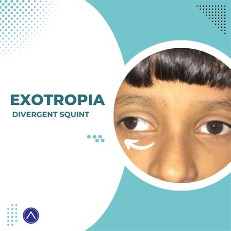 Image result for Exotropia and Computer