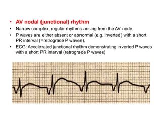 Image result for PR Interval Abnormalities