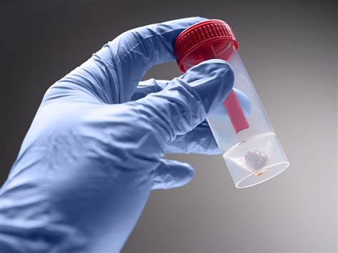 Image result for Stool Sample Test