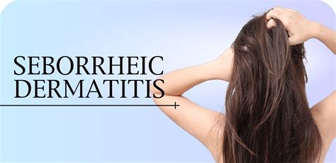 Image result for Seborrheic Dermatitis Contagious