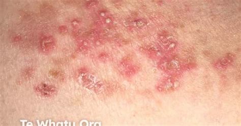 Image result for Types of Pustular Psoriasis