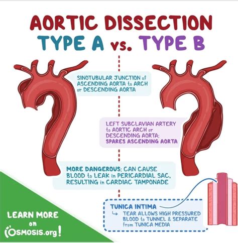 Image result for Type 2 Aortic Dissection