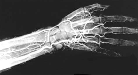 Image result for Hand Angiogram