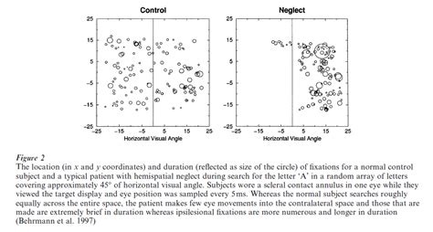 Image result for Contralateral Neglect