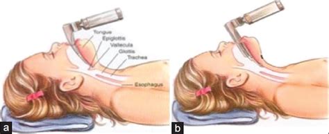 Image result for Intaocular Intubation