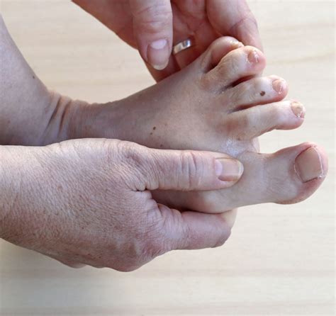 Image result for Toe Jam Build Up