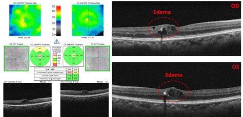 Image result for Oct Retinal Scan Interpretation