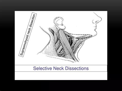 Image result for Types of Neck Dissection