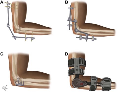 Image result for External Fixator Surgery
