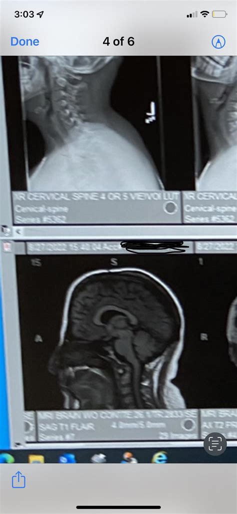 Image result for X-Rays for Basilar Invagination