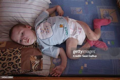 Image result for Birth Defects From Chernobyl Disaster