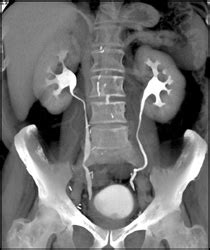 Image result for Urogram CT Scan with Contrast Normal