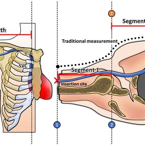 Image result for Pic Calculation Formula
