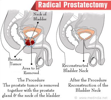 Image result for Prostatectomy Surgery Procedure