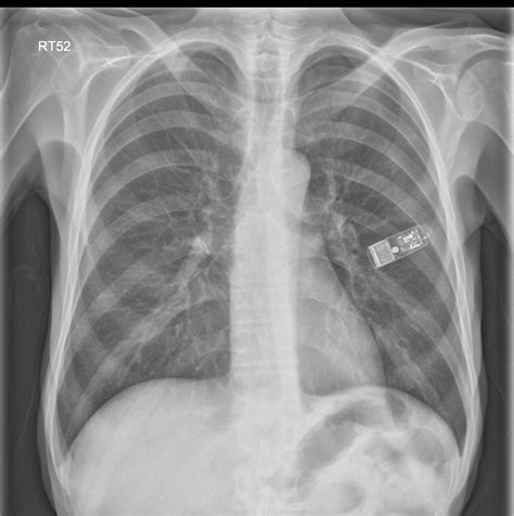 Image result for Loop Recording Device