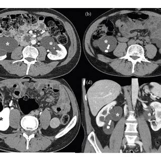 Image result for Nephrogram Phase Timing