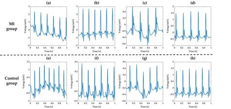 Normal ECG waveforms. | Download Scientific Diagram