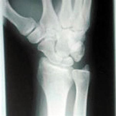 Image result for Wrist Arthrogram