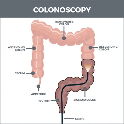 Image result for Normal Bowel Colonoscopy