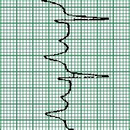 Image result for AV Block PR Interval
