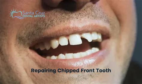Image result for DIY Front Tooth Chip Repair Kit
