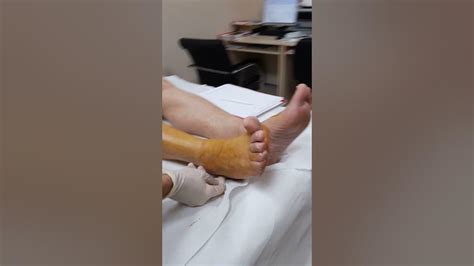 Image result for Chaddock Reflex Video