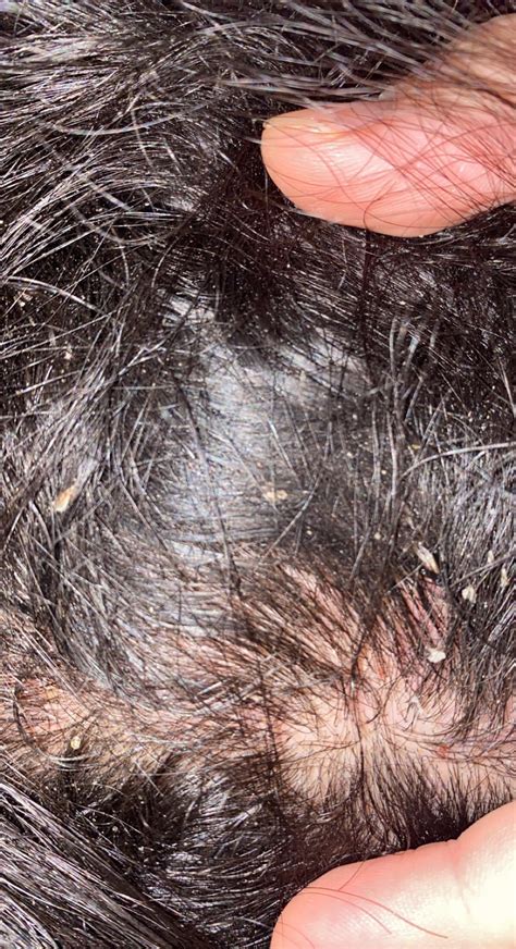 Image result for Seb Derm