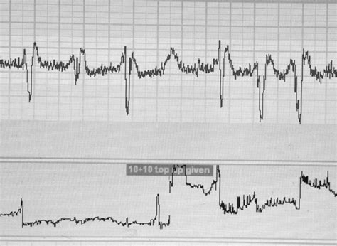 Image result for Variable Decelerations