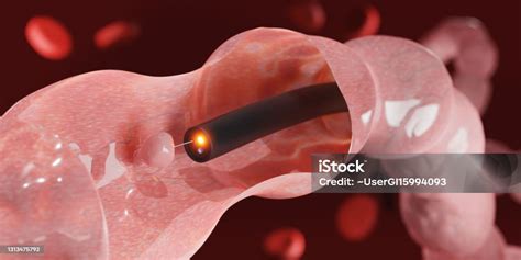 Image result for Colonoscopy Clips for Polyps