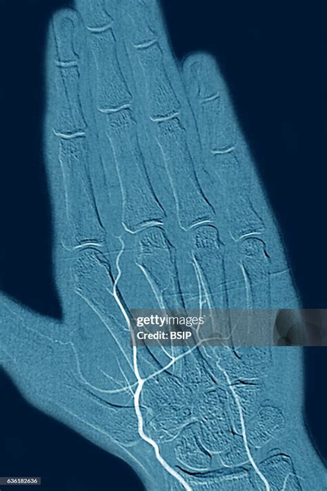 Image result for Hand Angiogram