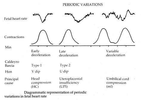 Image result for Variable Decelerations