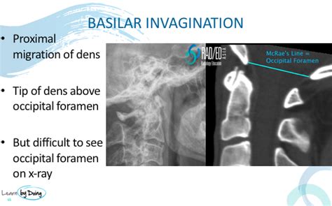 Image result for X-Rays for Basilar Invagination