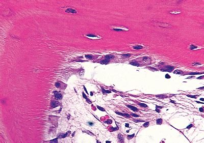 Image result for Types of Abnormal Bone Formation