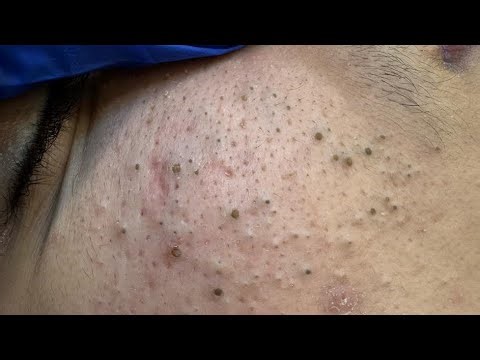 Deep Cleansing Facial Routine for Acne | Blackhead and Whitehead Removal