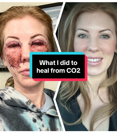 When it comes to healing after laser treatments, Vitamin A is truly the gold standard. If I were to go through the process again, I’d likely layer in some exosomes and growth factor serums alongside my Environ routine to speed up recovery. If you’re planning on an ablative skin treatment and have any questions, please drop them in the comments or feel free to send me a DM! #environskincare #vitamina #skincaretip #stgeorgeutah #lasvegas