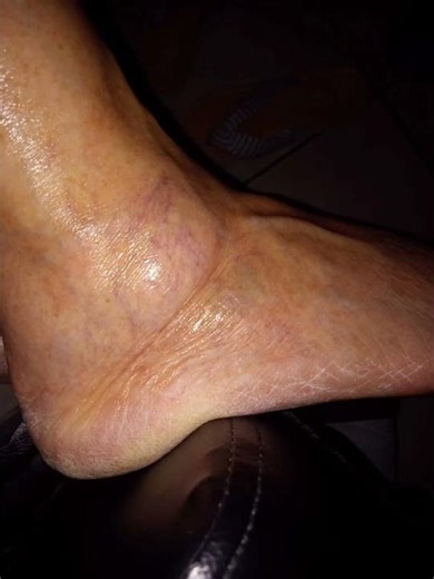 is this a bloodclot or siatica?