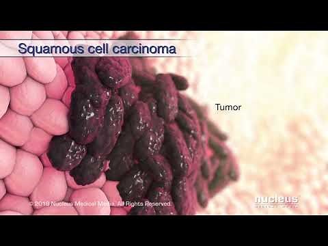 What is Head and Neck Cancer?