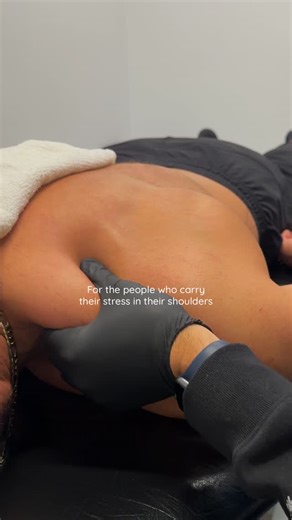 IMS for Upper Trap Tension The upper trapezius often becomes overactive from desk posture, stress, and repetitive shoulder use—leading to neck pain, headaches, and stiffness. Intramuscular Stimulation (IMS) uses a fine needle to target trigger points within the muscle, creating a reflex response that helps: • reduce muscle tone • improve blood flow • restore normal movement • decrease pain and tension By addressing the neurological source of tightness—not just stretching the muscle—IMS helps the