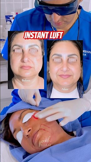 How This Non-Surgical Procedure Gives You a Facelift (and Why It’s So Popular)