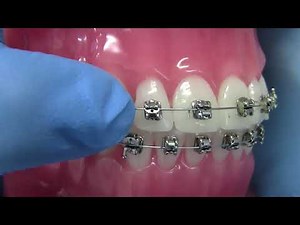 How to Manage a Open Bracket (Orthodontic emergency)