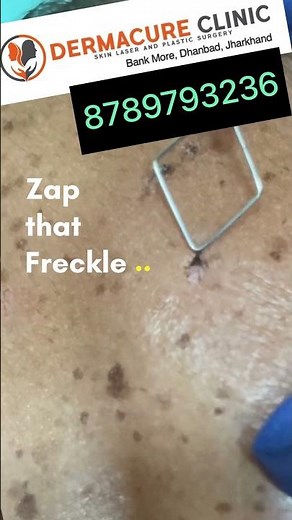 Freckles - How Laser Transforms the Face