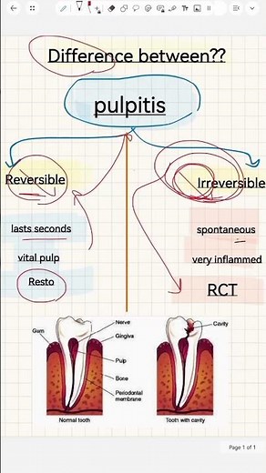 Difference between reversible pulpitis and irreversible pulpitis #dentistry #denta #dental