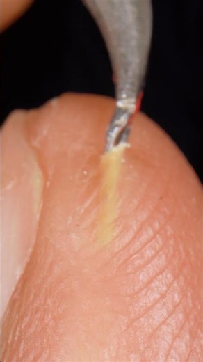 ASMR splinter removal under-skin extraction CLOSE-UP (macro-zoom in) pt2 #asmr #asmrsounds #closeup