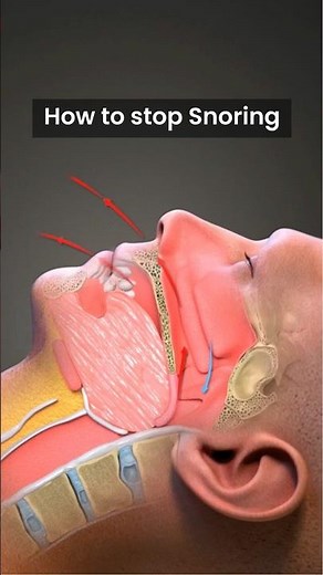How to stop Snoring? ↪ 3D Medical Animation #Shorts #StopSnoring #Sleep #Snoring