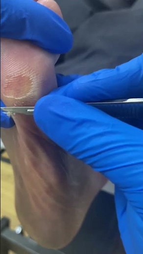 Podiatrist's Guide to Pain-Free Corn Removal Learn How It's Done #Podiatry #FootCare