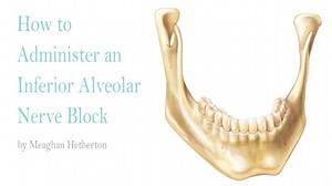 How To Administer An Inferior Alveolar Nerve Block