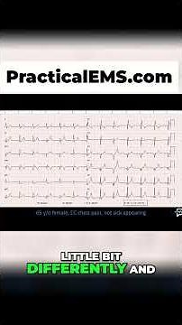 ECG Pacer Spikes: Unmasking Ventricularly Paced Rhythms #shorts