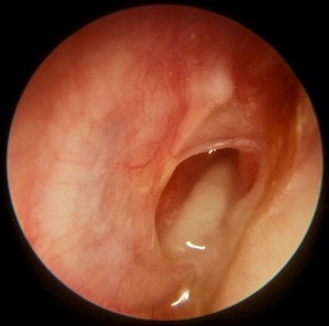 Inner Ear Infection - Symptoms, Causes, Treatment, Pictures