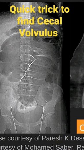 cecal volvulus