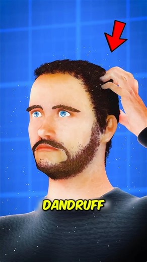 Why You Really Get Dandruff